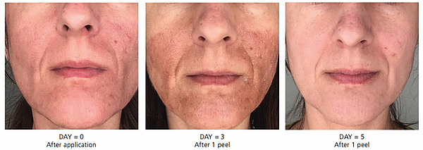Prodigy Peel | Chemical Peeling | Schön & Schöner | Stuttgart